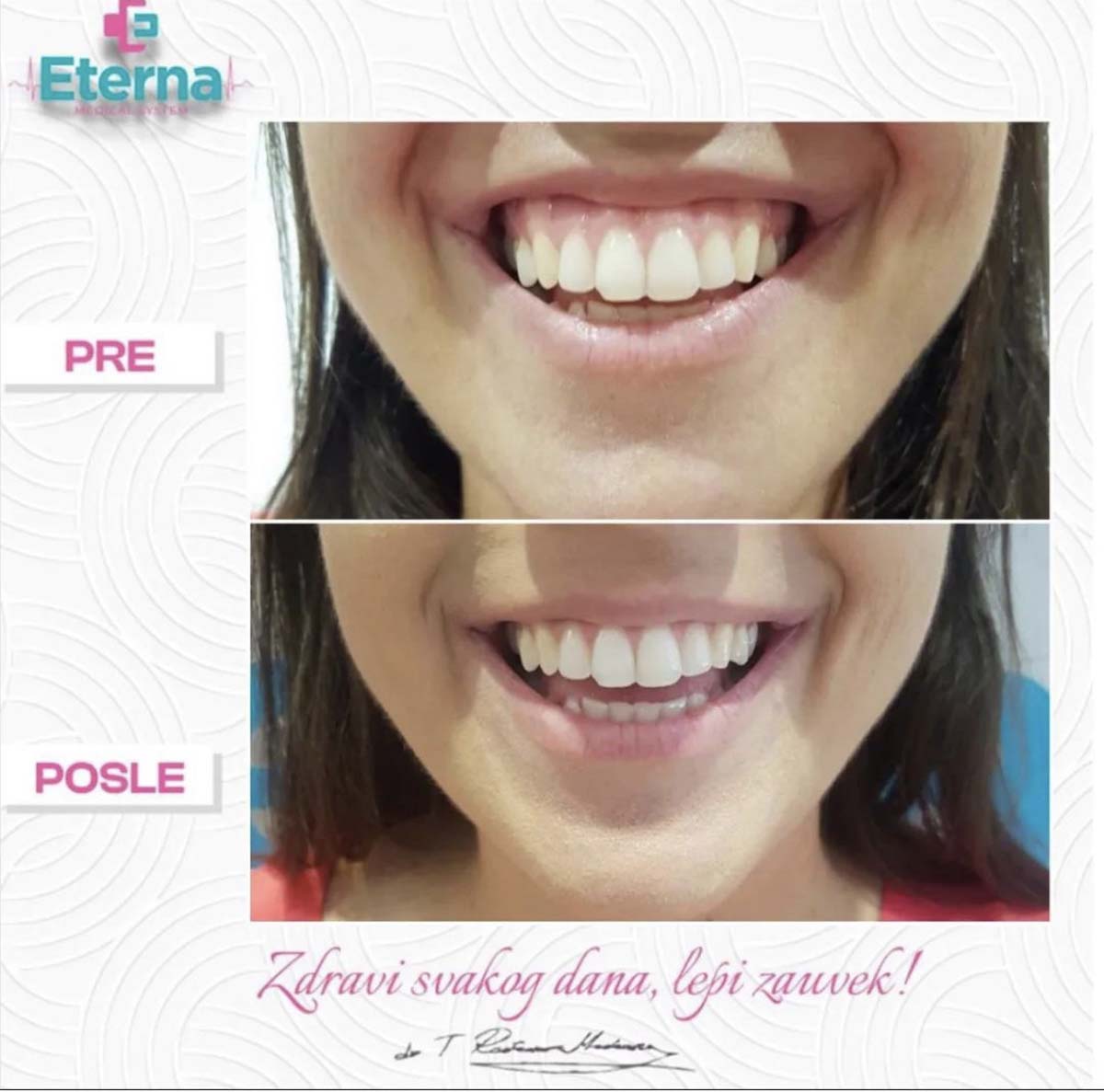Gummy smile, gingivalni osmeh - Eterna Medical System & Hospital
