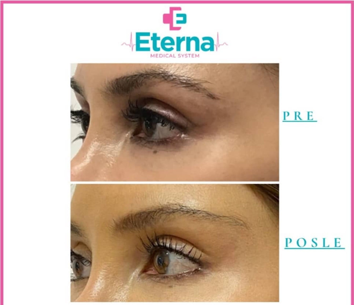 Podizanje obrva - Eterna Medical System & Hospital