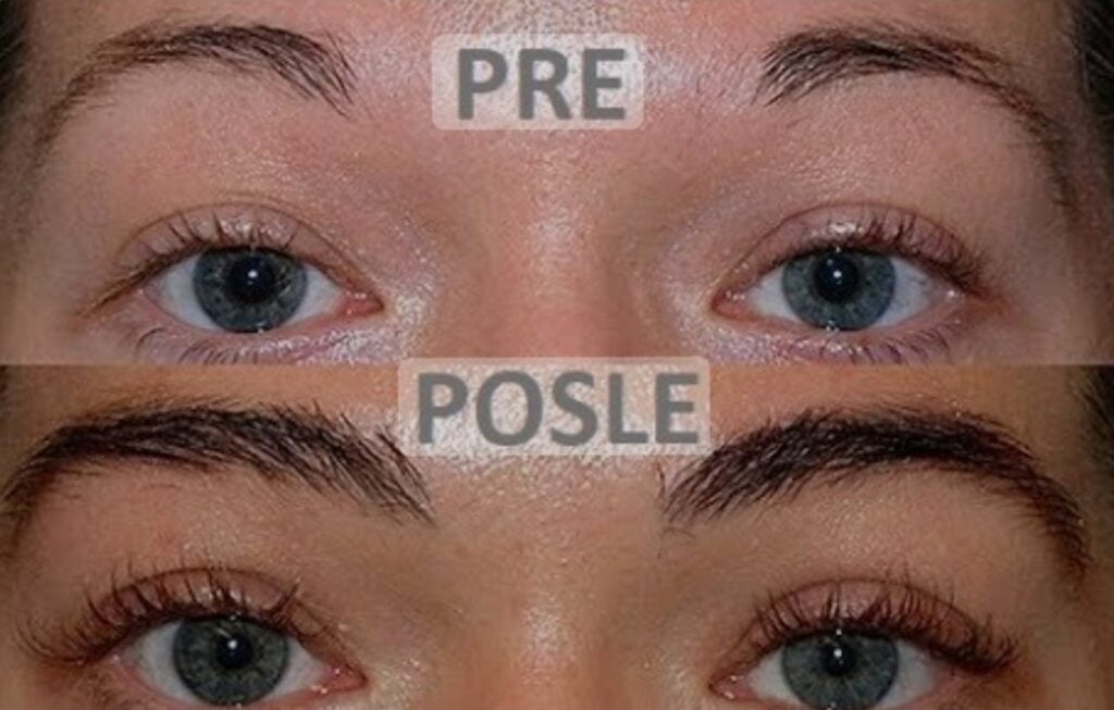 Transplantacija obrva - Eterna Medical System & Hospital