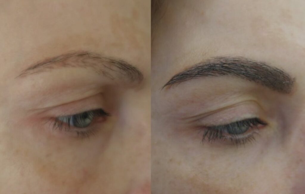 Transplantacija obrva - Eterna Medical System & Hospital